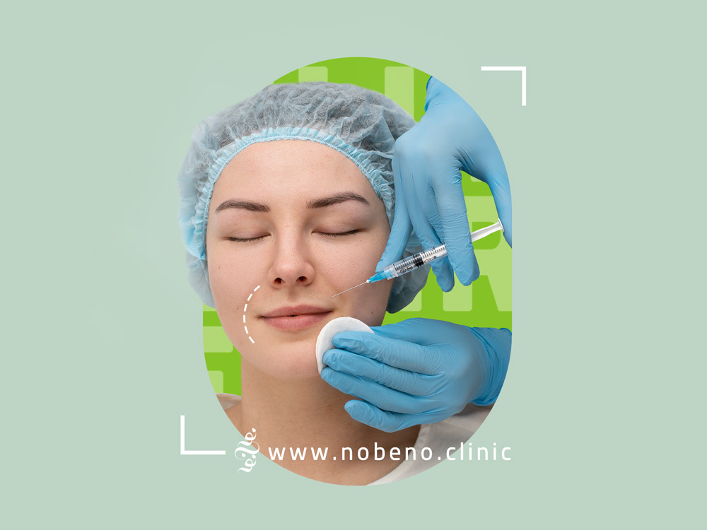هر آنچه در مورد فیلر خط خنده باید بدانیم - کلینیک زیبایی نو به نو